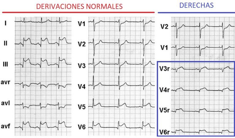 Derivaciones derechas y posteriores del electrocardiograma