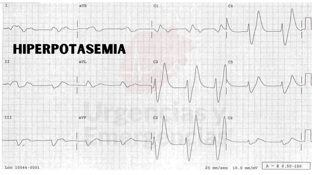 Hiperpotasemia: algoritmo ERC 2021 y electrocardiograma