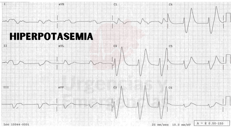 Hiperpotasemia: algoritmo ERC 2021 y electrocardiograma